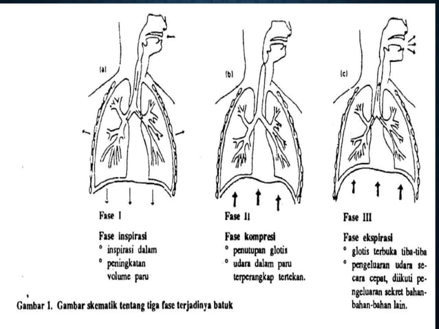 Patofisiologi batuk | PPTX