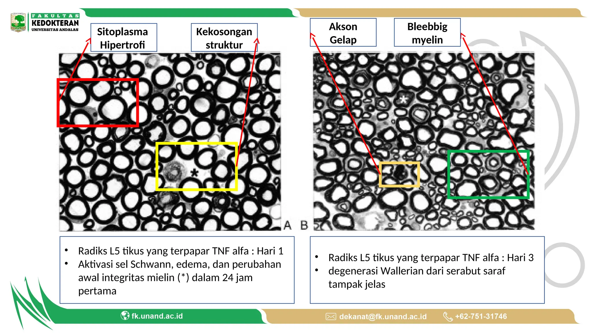 Patofisiologi HNP untuk bahan bacaan.ppt