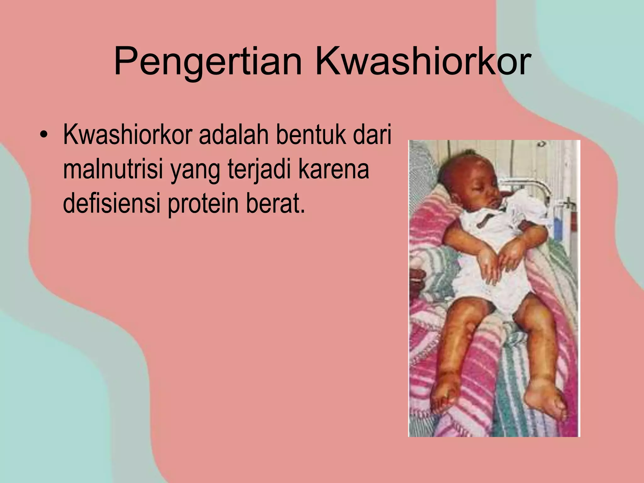 Patofisiologi kwashiorkor.pptx