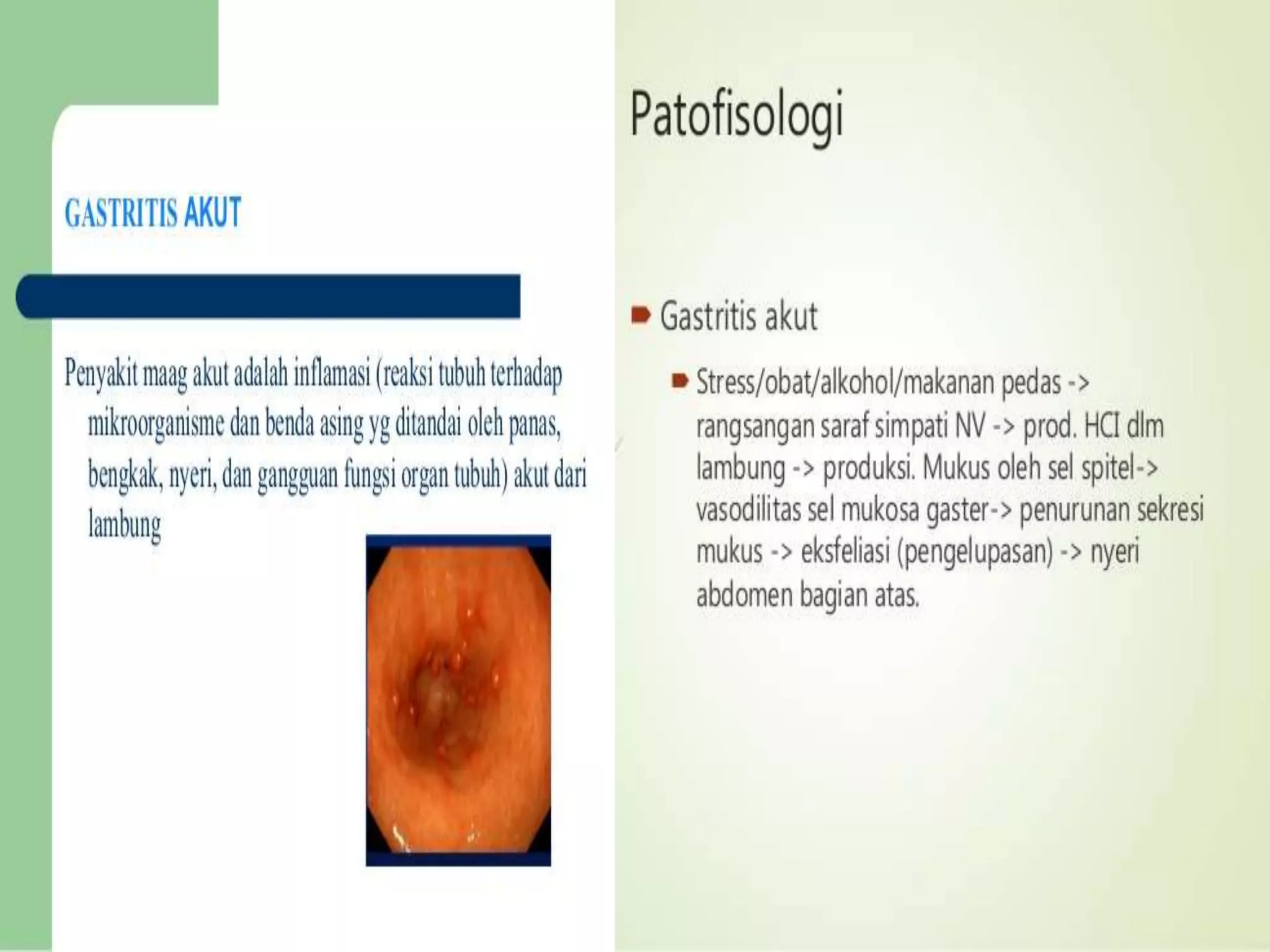 PEPTIC ULCER TUKAK LAMBUNG Patofisiologi peptic ulcer | PPTX