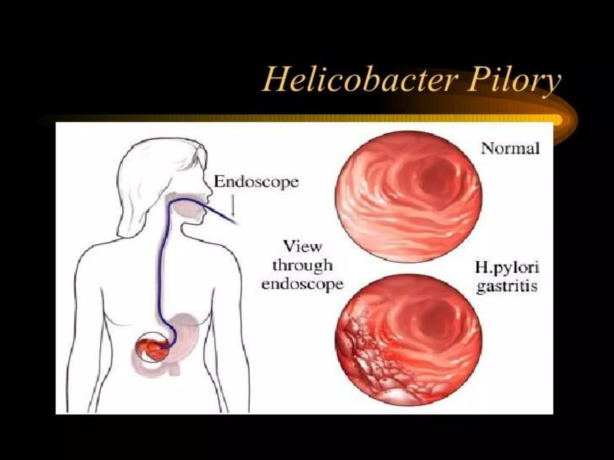 PEPTIC ULCER TUKAK LAMBUNG Patofisiologi peptic ulcer | PPTX