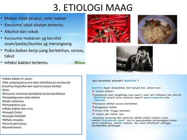 PEPTIC ULCER TUKAK LAMBUNG Patofisiologi peptic ulcer | PPTX