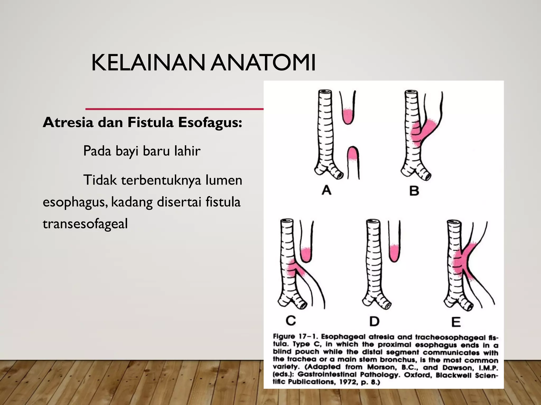 Patofisiologi Penyakit Peptic Ulcer.pdf
