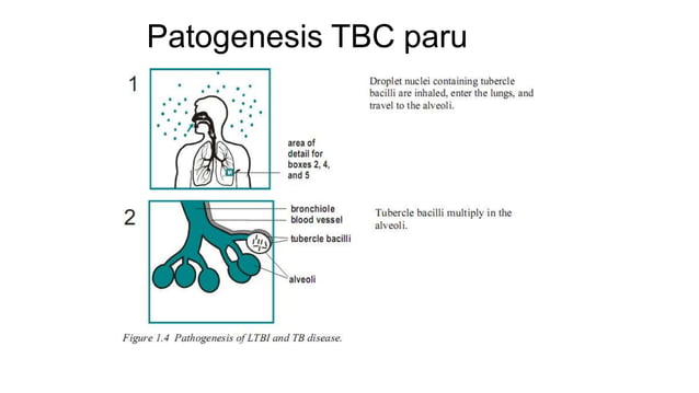 Patogenesis TB paru.pptx