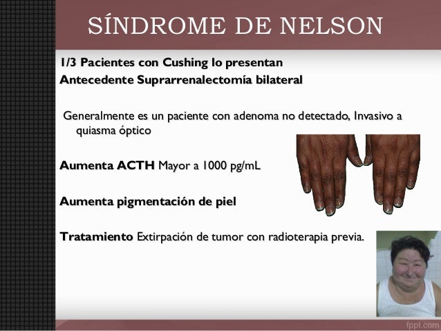Nelsons Syndrome