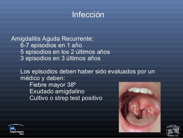 Patología amigdalina y amigdalectomía