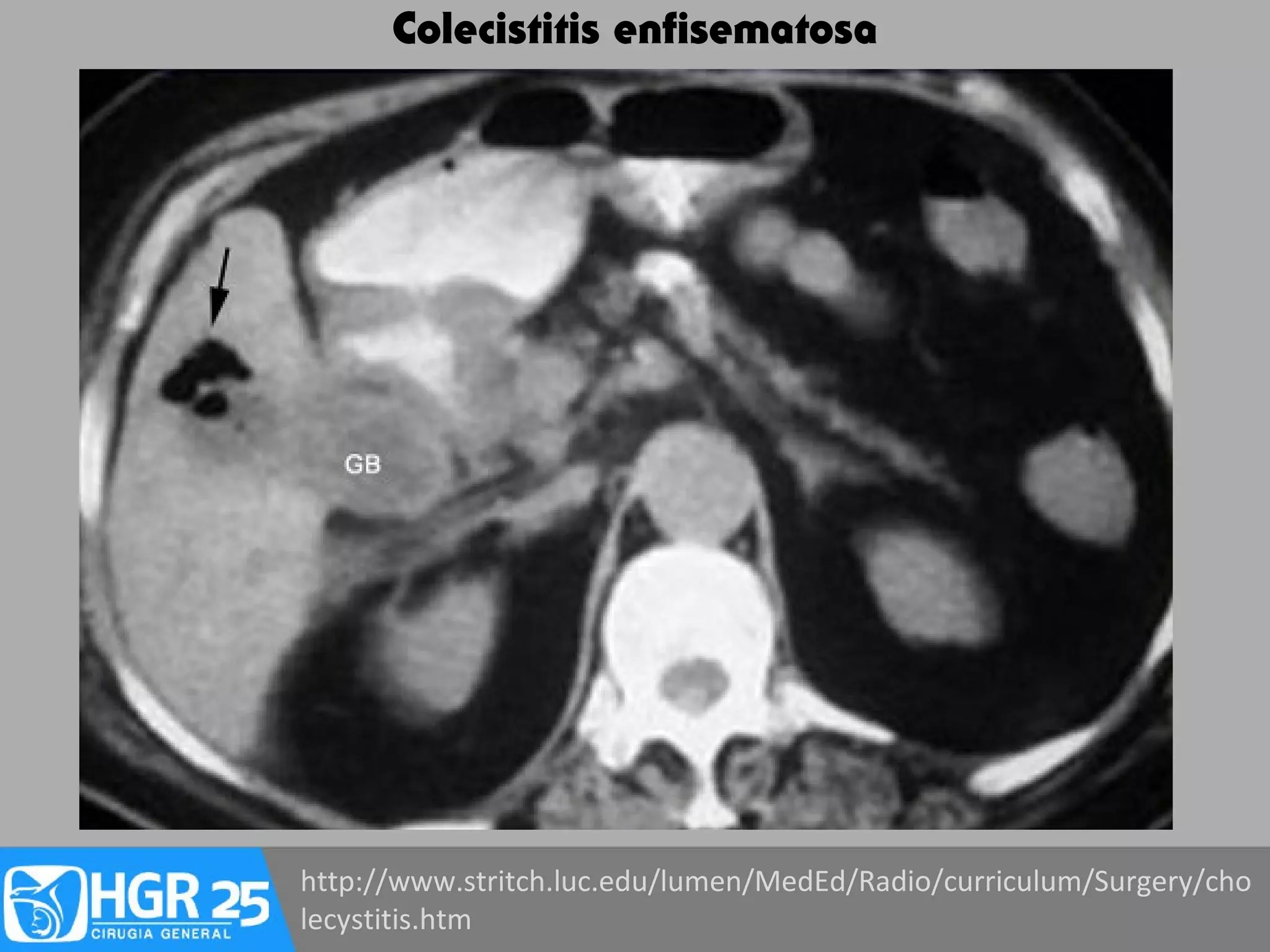 Patología benigna y maligna de vesícula y vias biliares | PPT