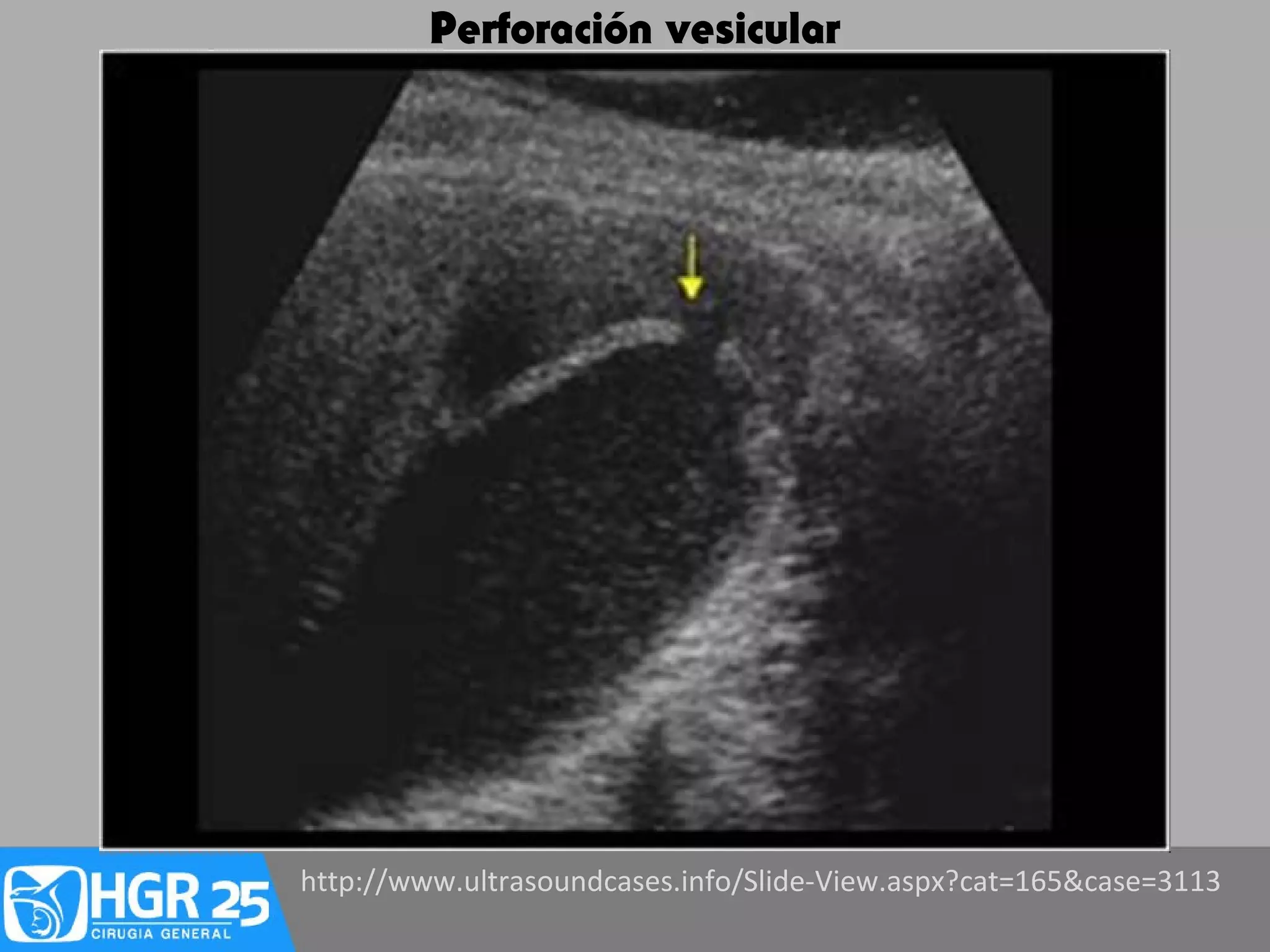 Patología benigna y maligna de vesícula y vias biliares | PPT