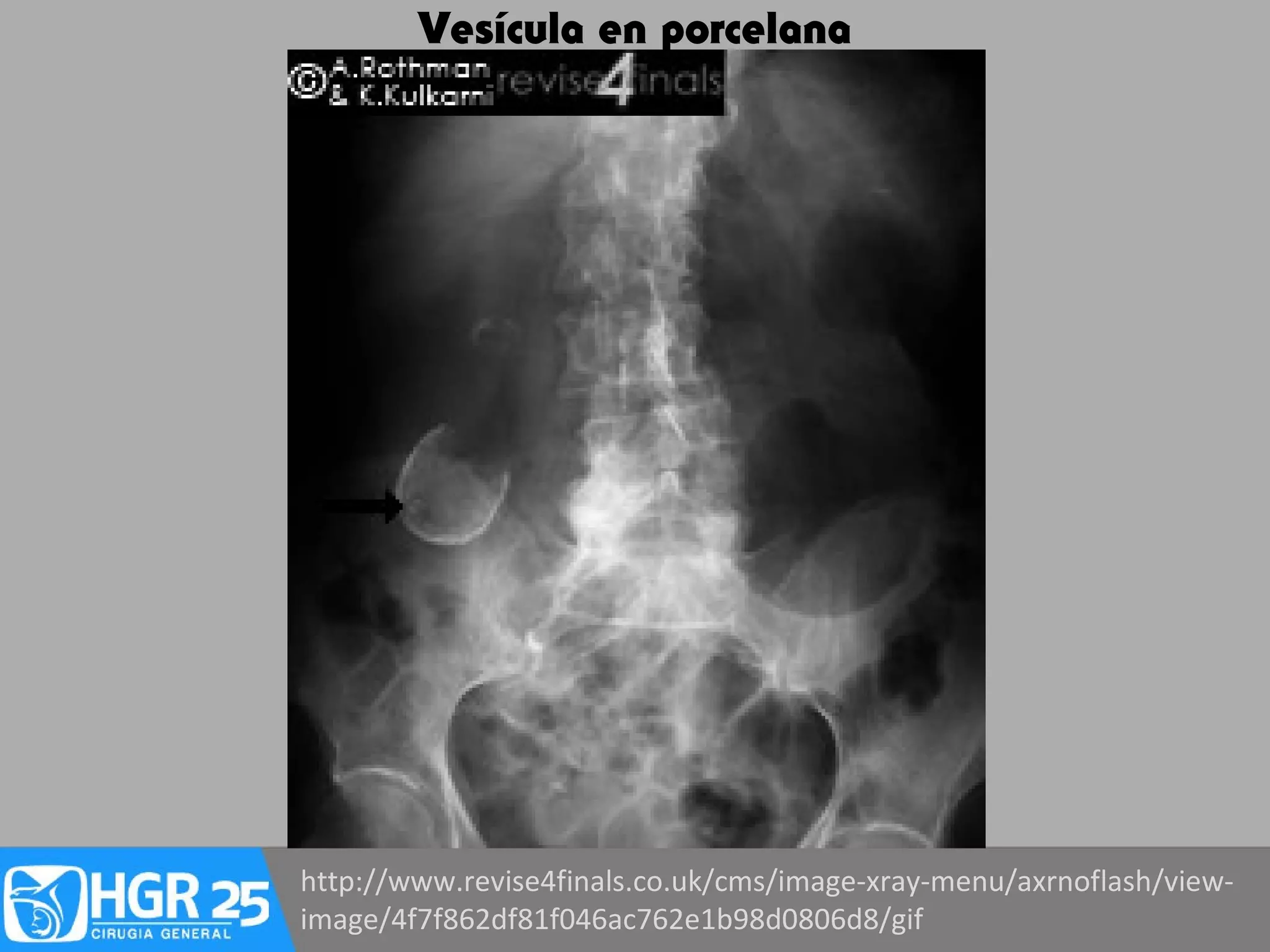 Patología benigna y maligna de vesícula y vias biliares | PPT