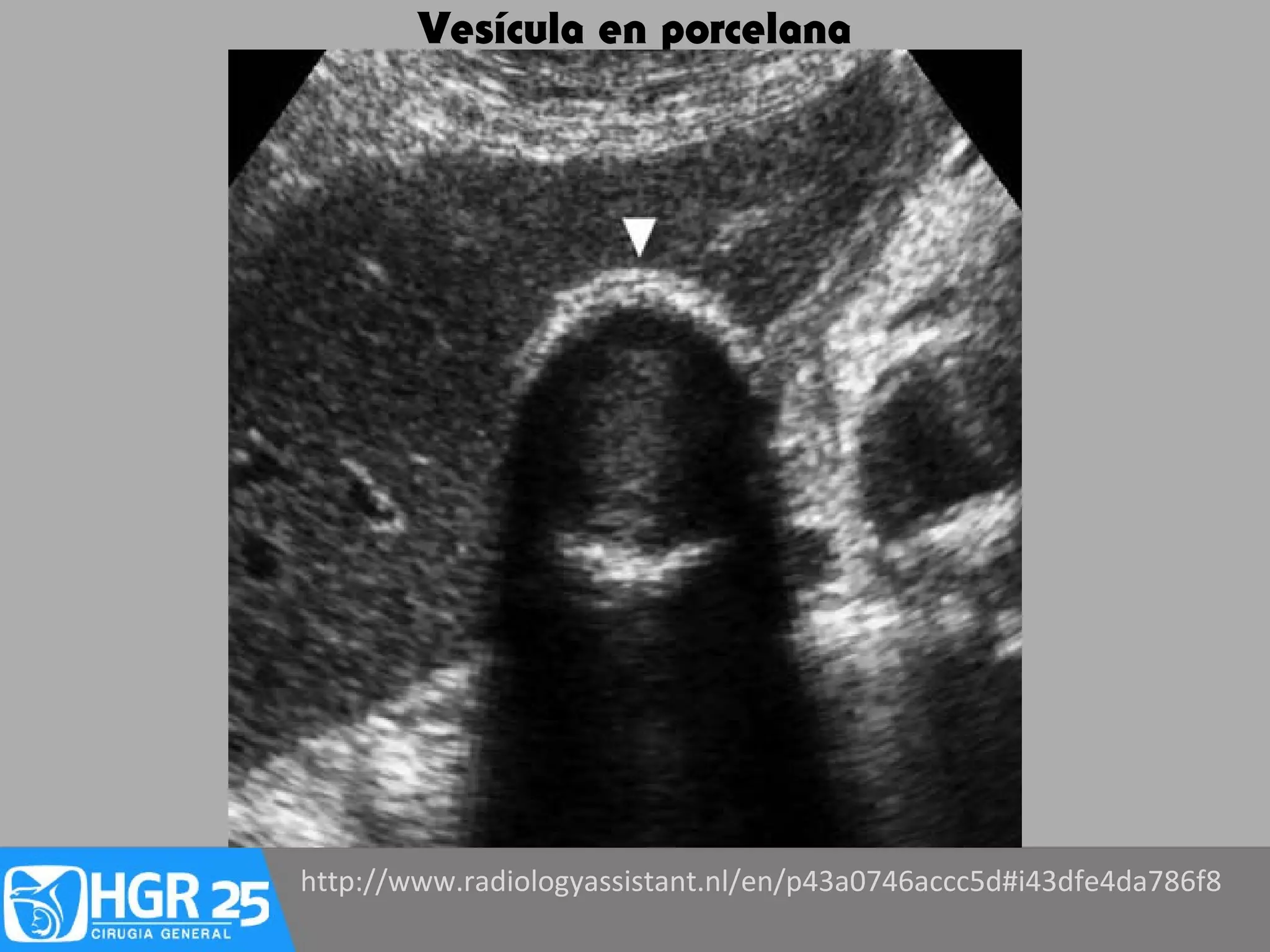 Patología benigna y maligna de vesícula y vias biliares | PPT