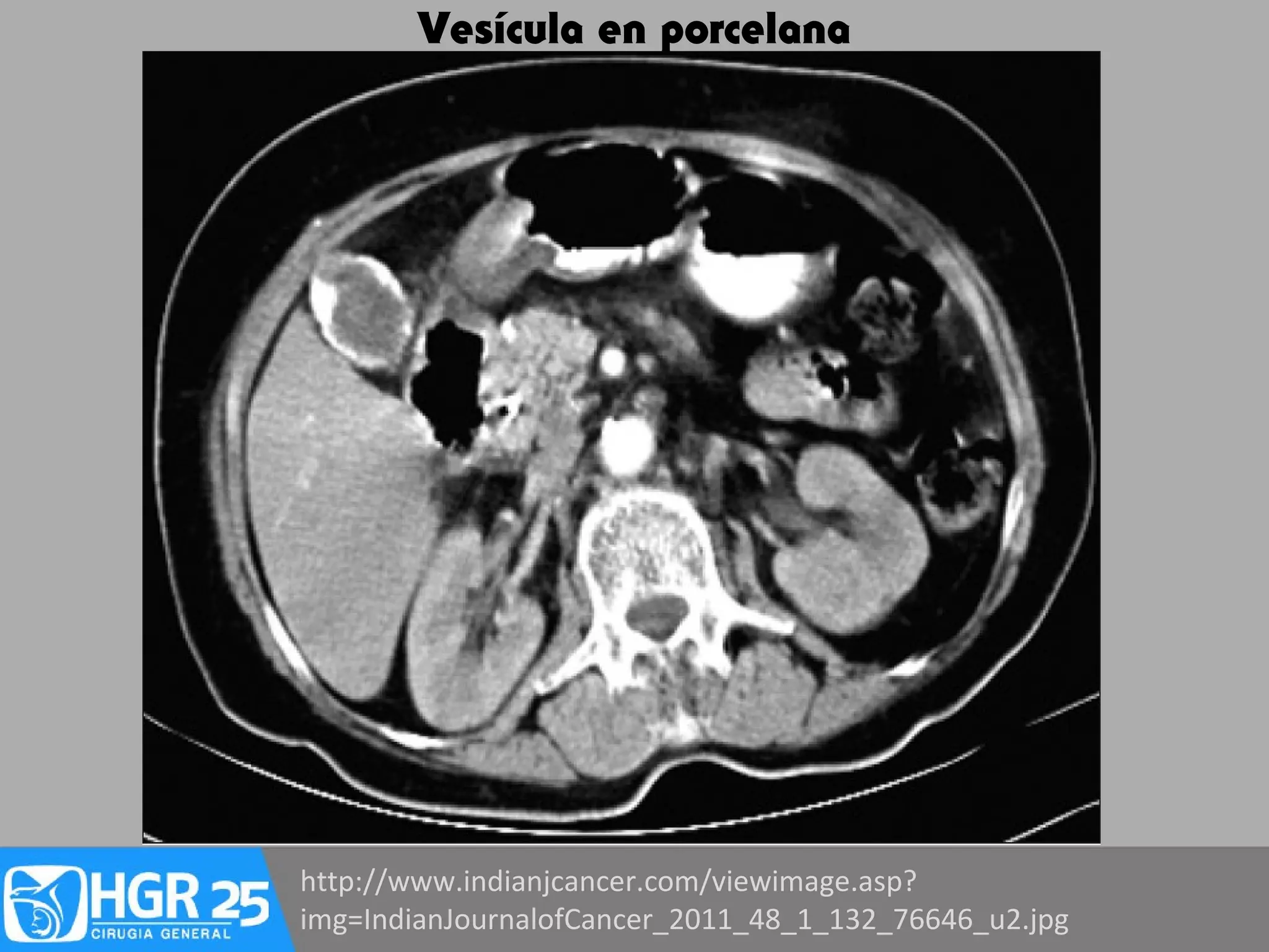 Patología benigna y maligna de vesícula y vias biliares | PPT