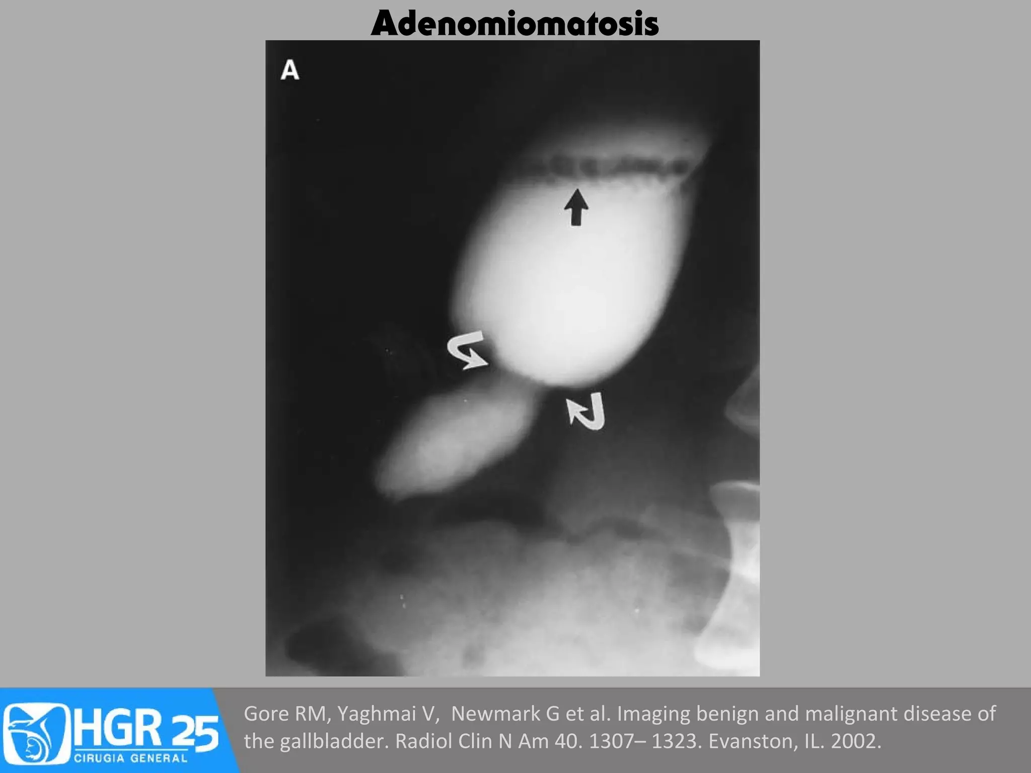 Patología benigna y maligna de vesícula y vias biliares | PPT