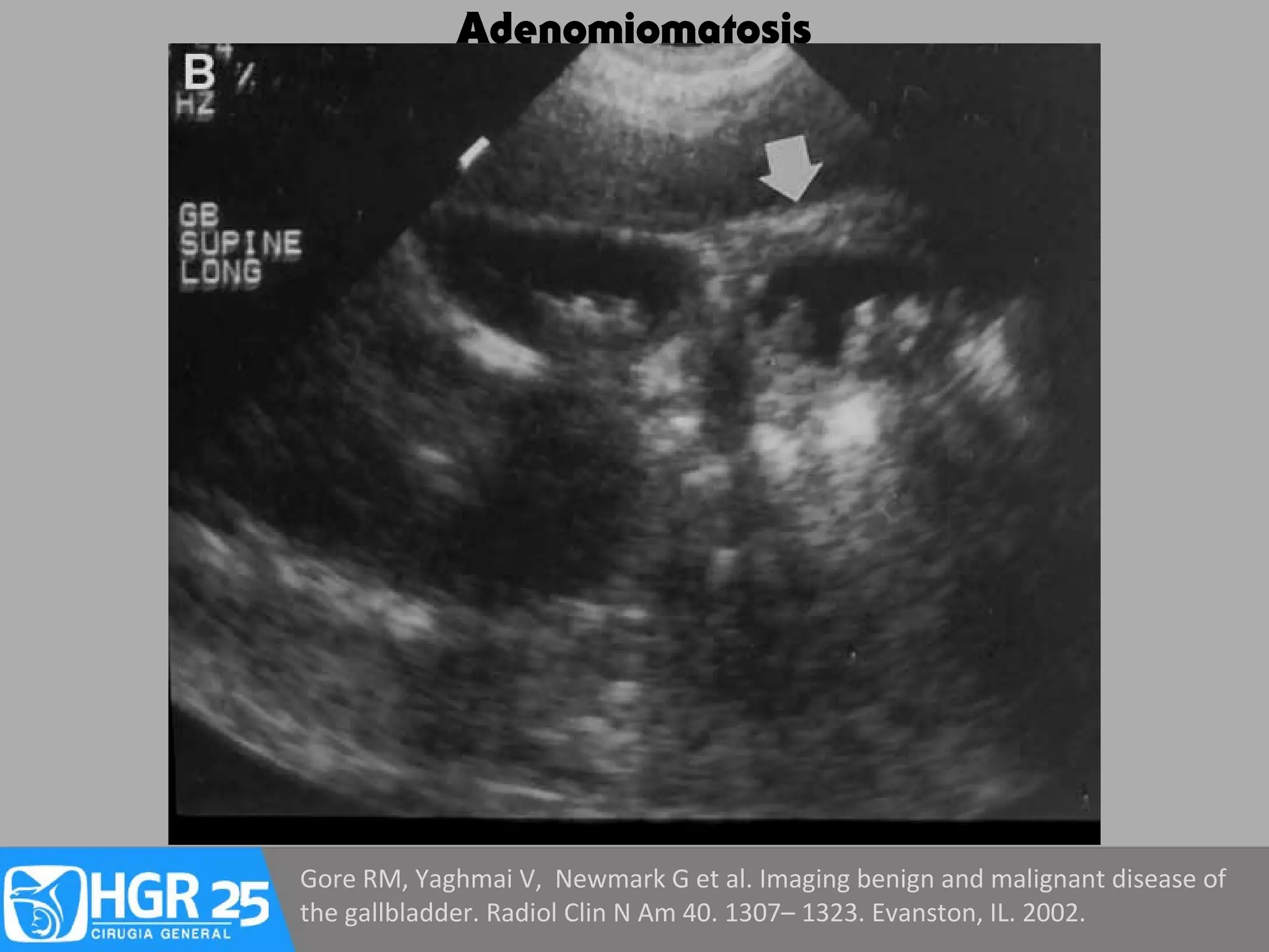 Patología benigna y maligna de vesícula y vias biliares | PPT