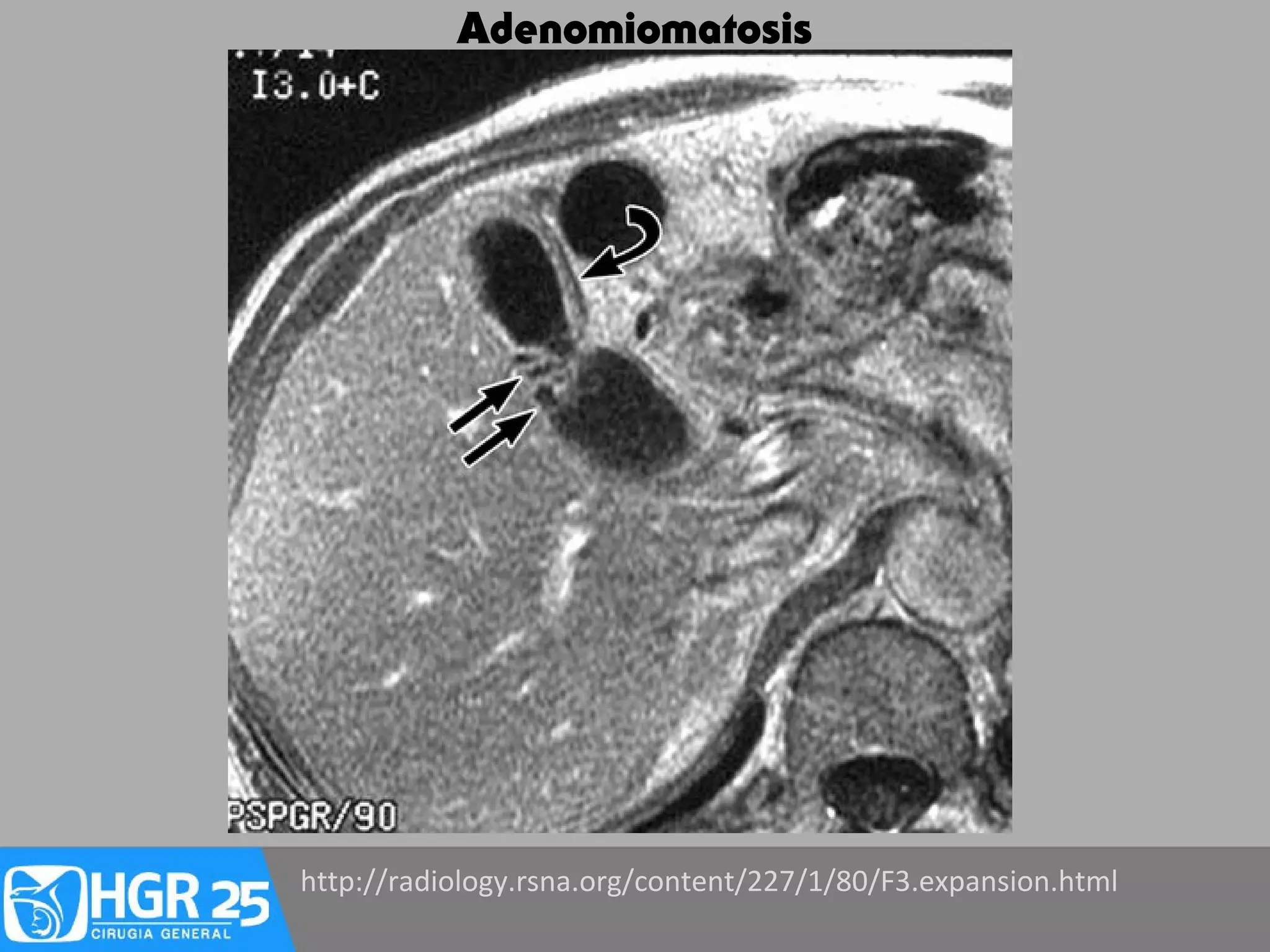 Patología benigna y maligna de vesícula y vias biliares | PPT