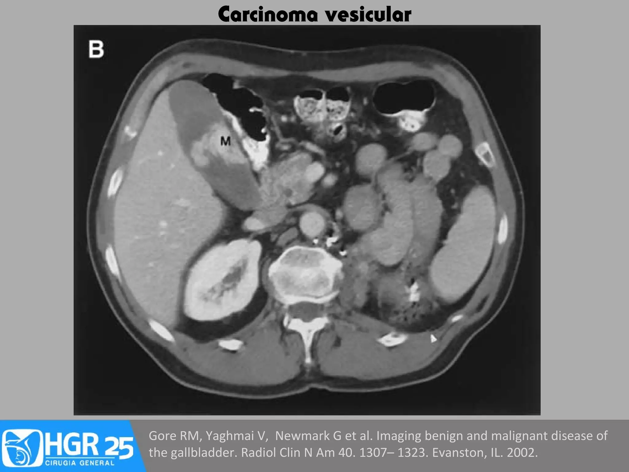 Patología benigna y maligna de vesícula y vias biliares | PPT