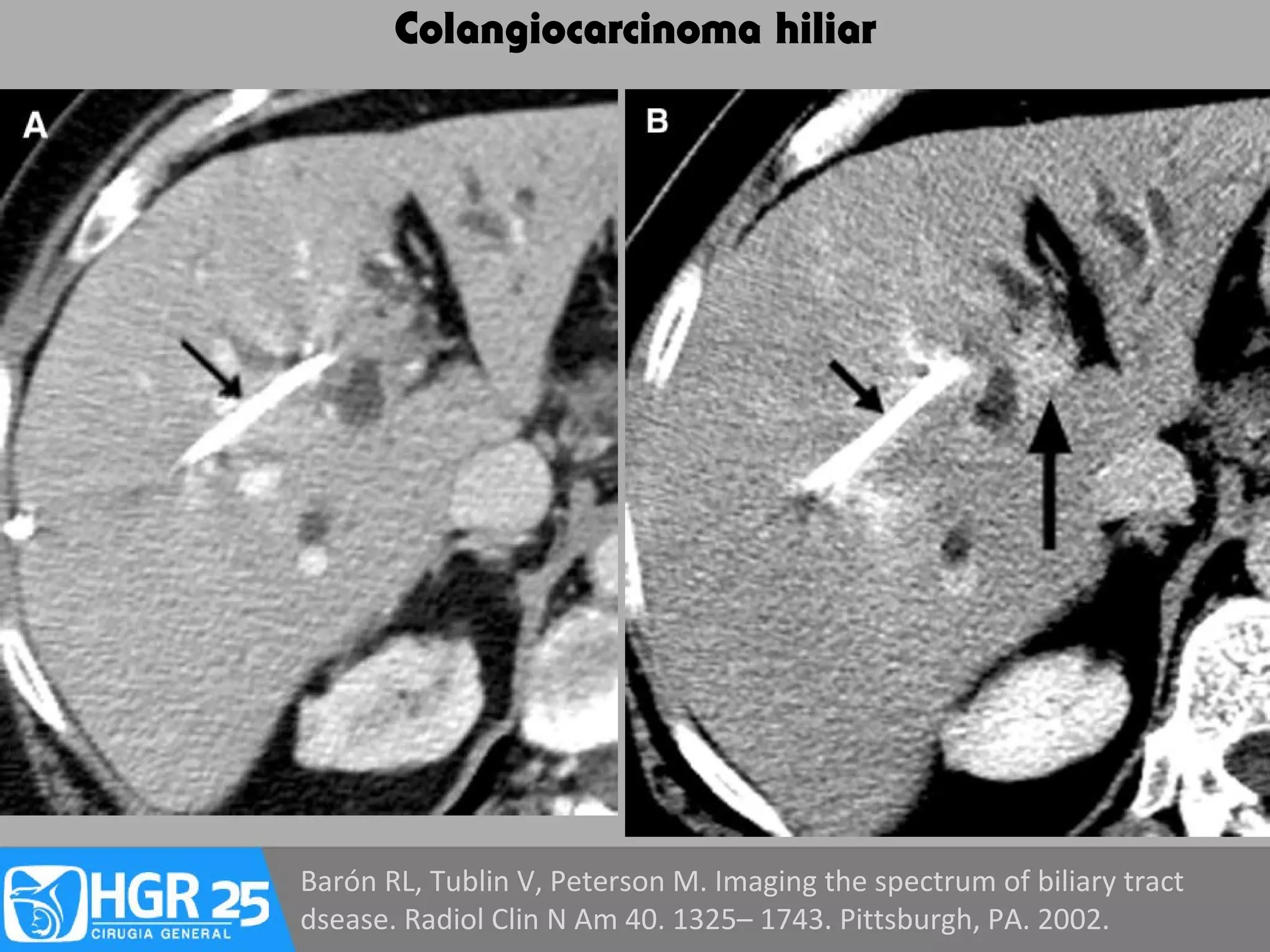 Patología benigna y maligna de vesícula y vias biliares | PPT