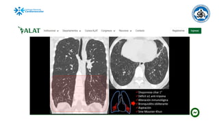 Patología Broncopulmonar ramificaciones.pptx