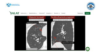 Patología Broncopulmonar ramificaciones.pptx