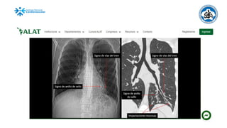 Patología Broncopulmonar ramificaciones.pptx