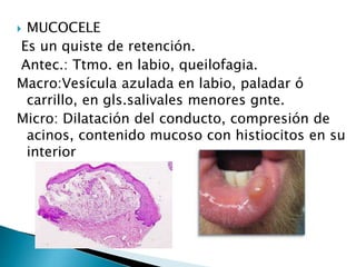PATOLOGÍA DE LAS GLÁNDULAS SALIVALES (1).ppt