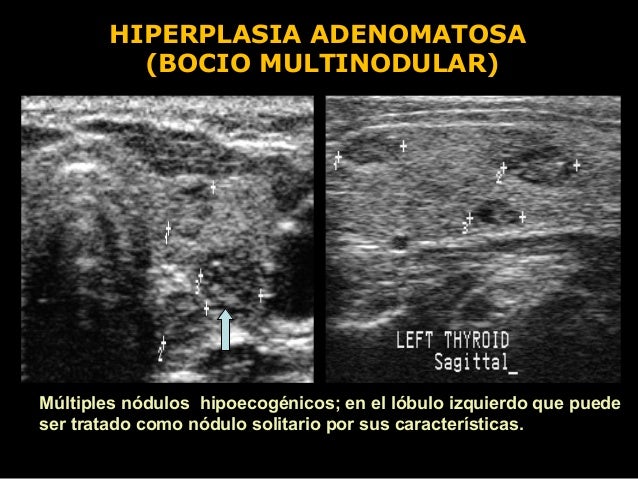 Patología del tiroides diagnóstico imagenológico.