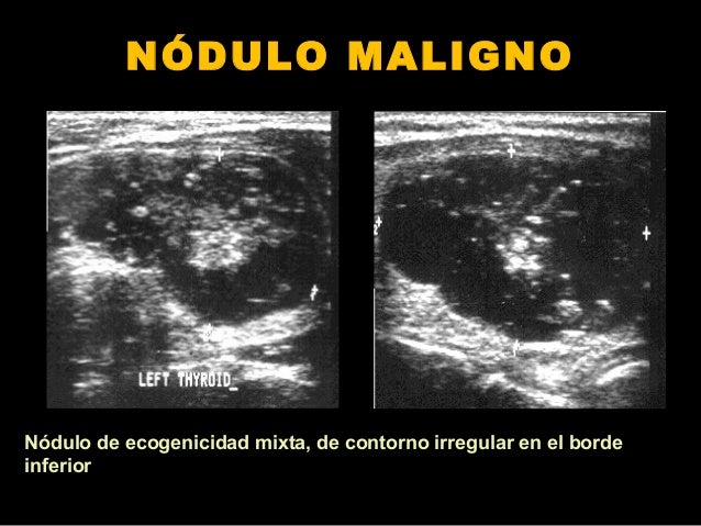 Patología del tiroides diagnóstico imagenológico.