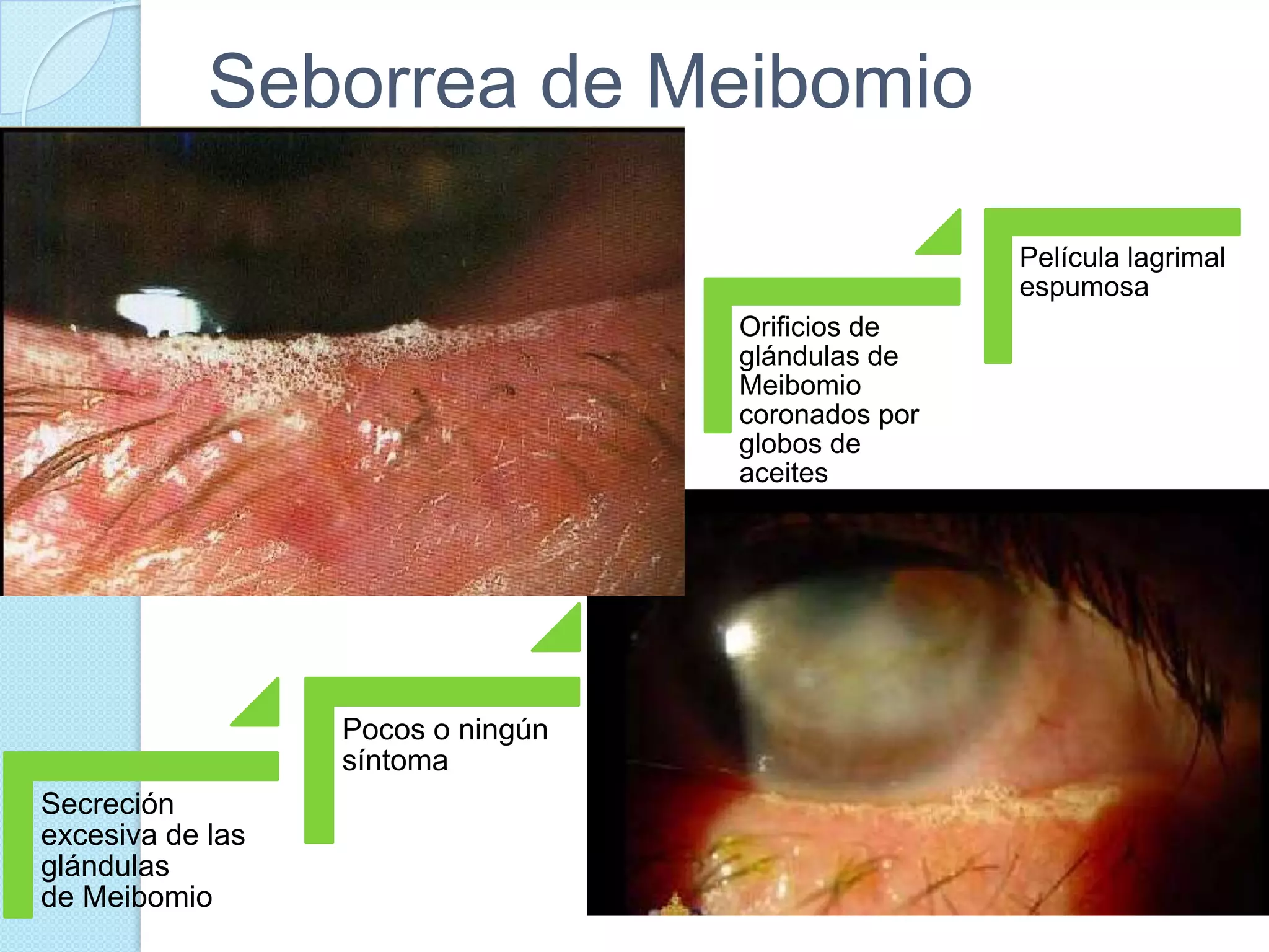 Patología de párpados. Blefaritis | PPTX | Eye and Vision Conditions ...