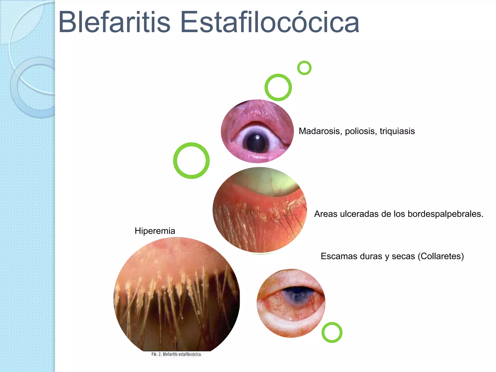 Patología de párpados. Blefaritis | PPTX | Eye and Vision Conditions ...