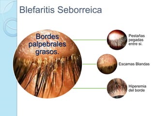 Patología de párpados. Blefaritis | PPTX