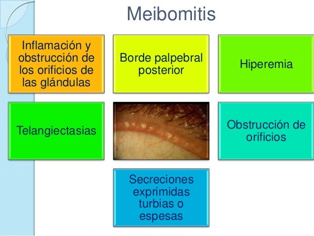 Patología De Párpados Blefaritis