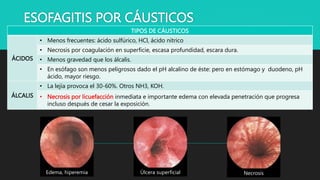 PATOLOGÍA ESOFÁGICA.pptx