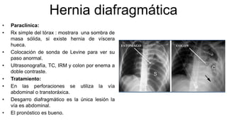 Patología esofágica y hernia diafragmática | PPTX