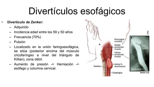 Patología esofágica y hernia diafragmática | PPT
