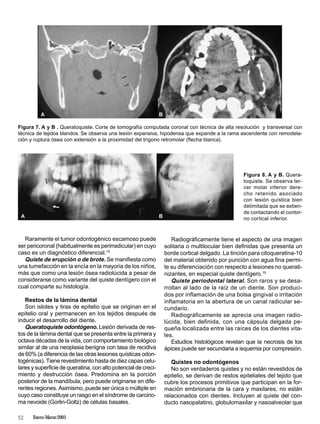 Patología Mandibular. Lesiones de carácter odontogénico | PDF