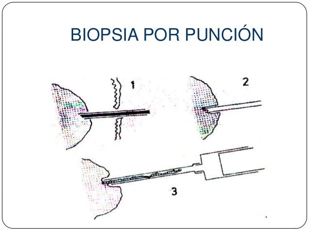 Biopsia Pulmonar Por Punción – Biopsia pulmonar – FEYY