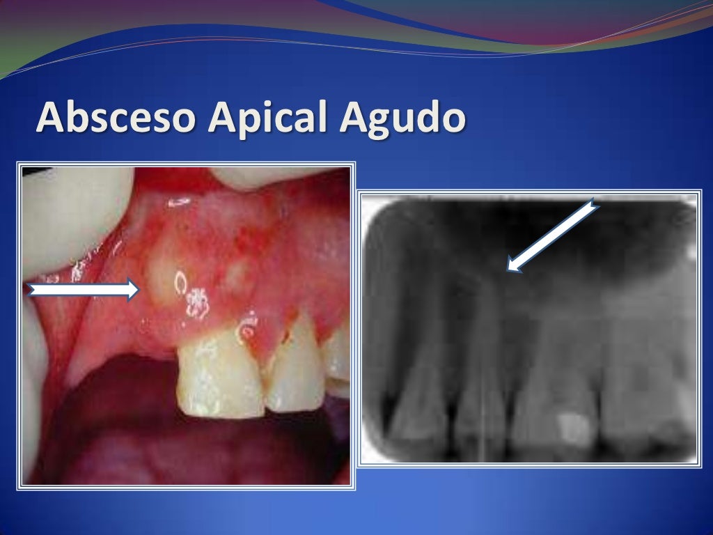 Patología periapical