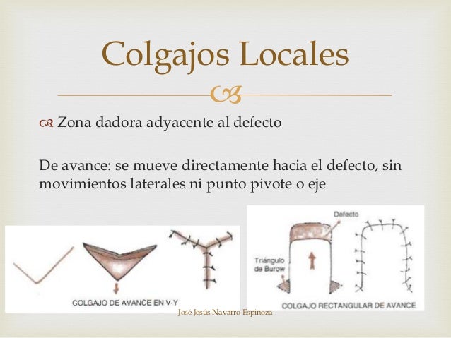 Colgajos Quirurgicos