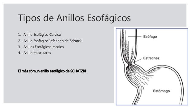 Patologías de esófago- CIRUGIA