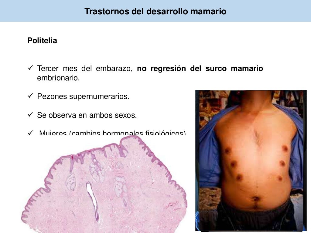 Patologías de la mama