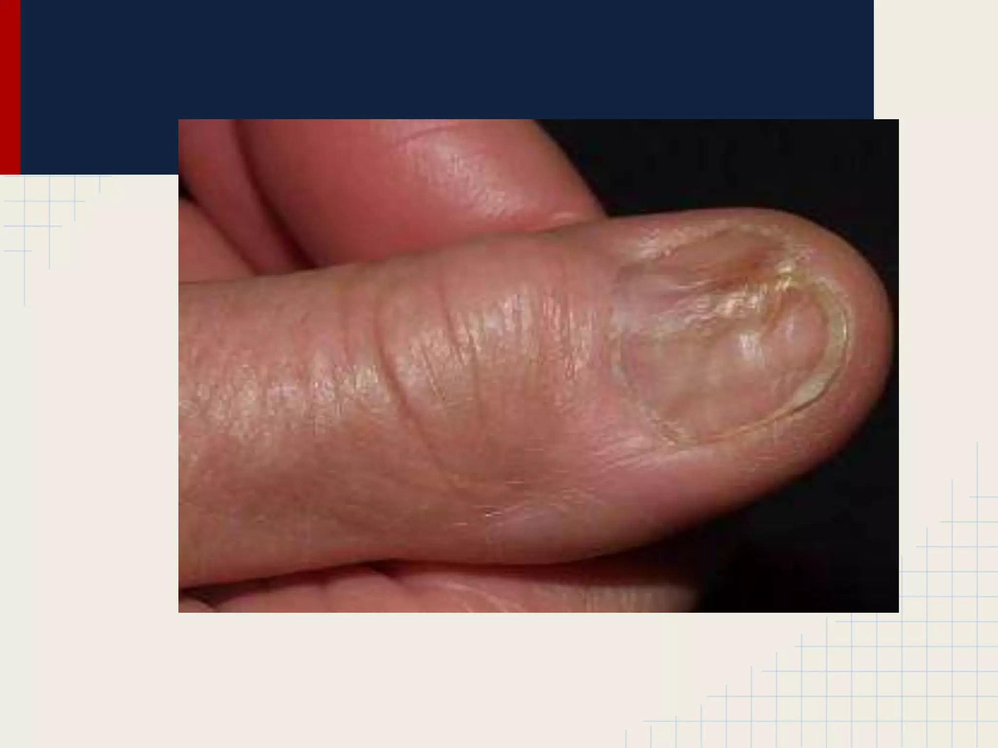 Patología ungueal PATOLOGIA DE LA UÑA ONICOMICOSIS , TRATAMIENTO ...