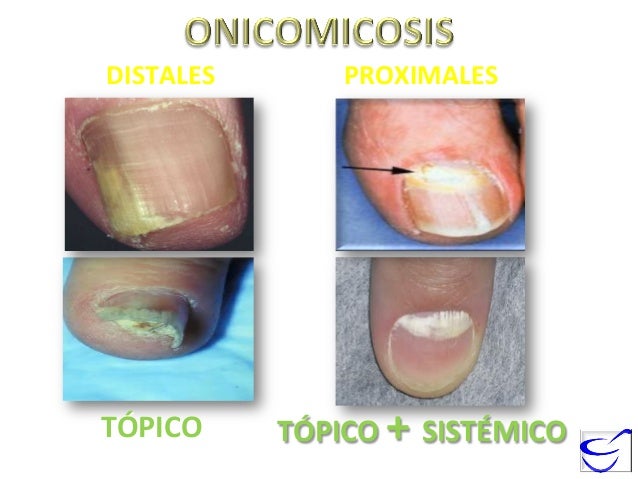 Patología ungueal en formulacion magistral teresa puertas - aedsc - 2…