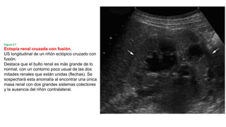 Patologia anomalia renal congenita rx us tc | PDF