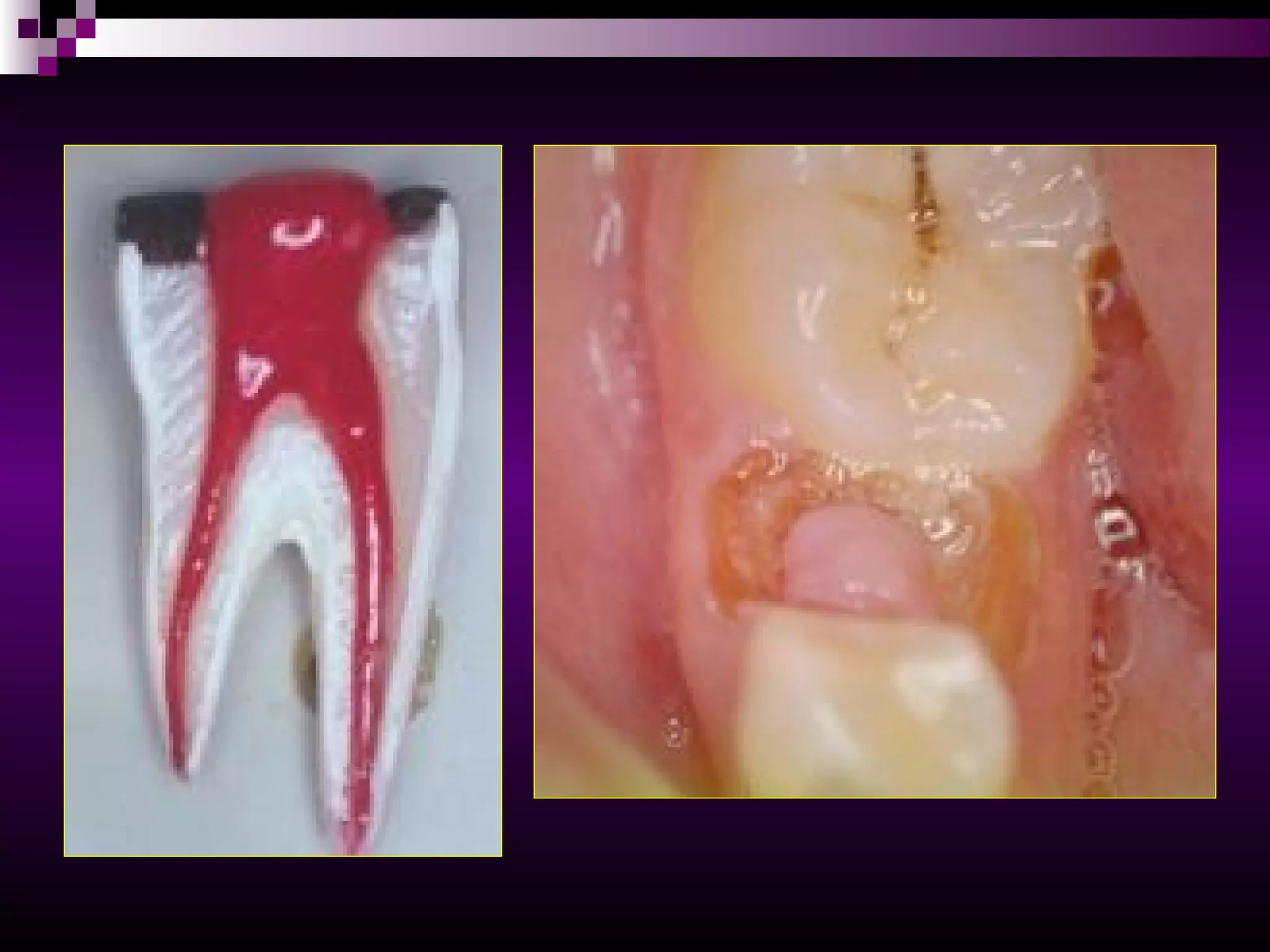 Patologia pulpar y patologia periapical | PPT