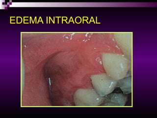 Patologia pulpar y patologia periapical | PPT