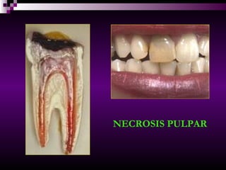 Patologia pulpar y patologia periapical | PPT