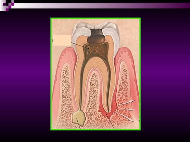 Patologia pulpar y patologia periapical | PPT