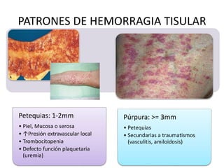 Patologia 5 a hiperemia y congestión | PPTX