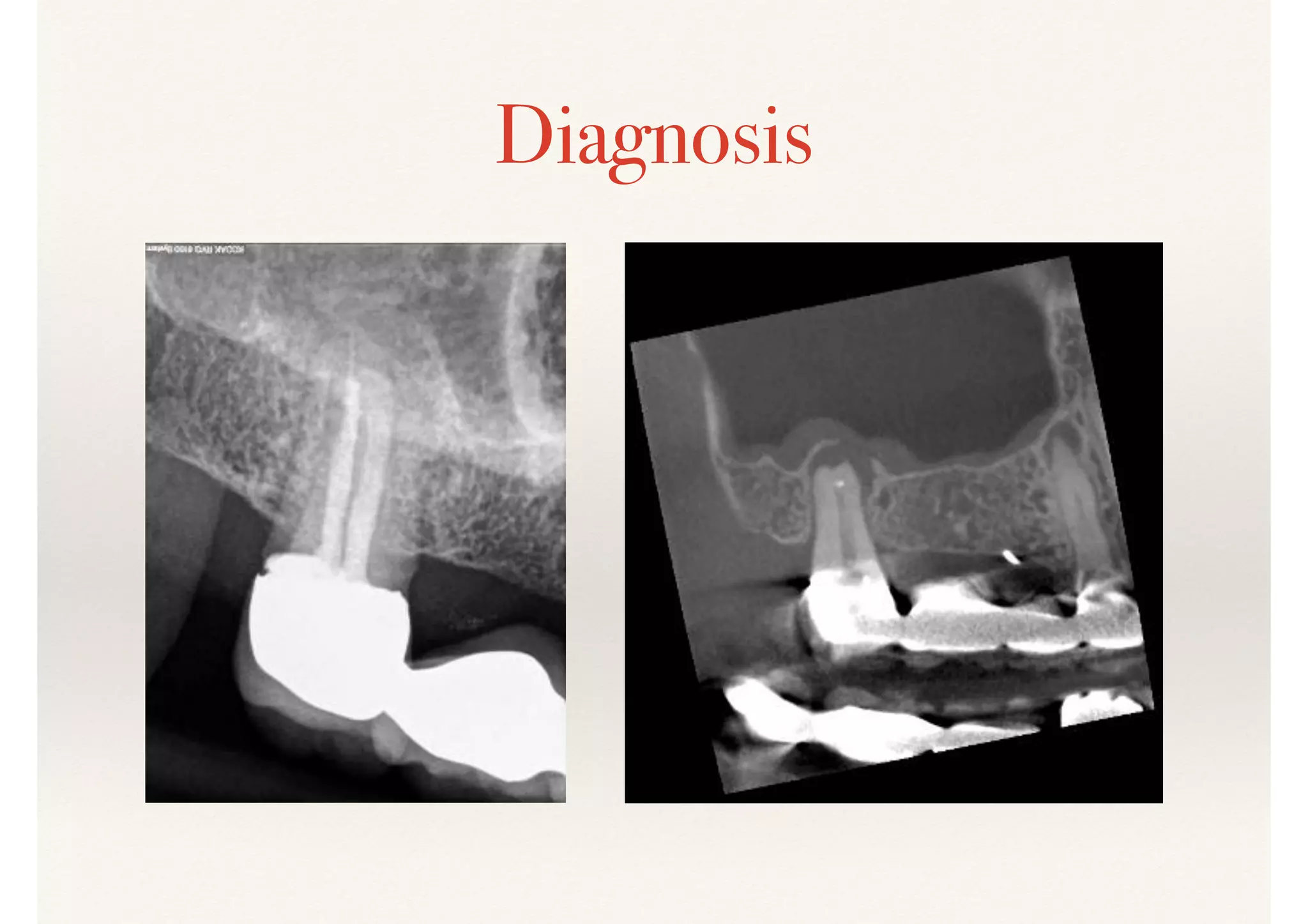 Patologia apicale e sinusite odontogena guida alla diagnosi e al ...