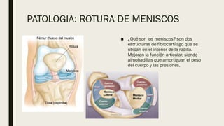 PATOLOGIA ARTICULAR - ROTURA DE MENISCOS.pptx
