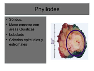 Patologia Benigna De La Mama | PPT